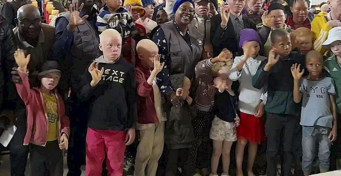 Govt Social Program Assists People with Albinism in Camacupa - Angola