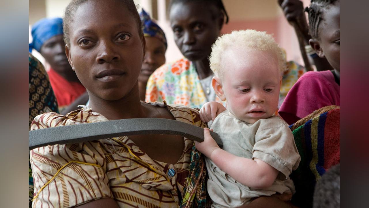 ALBINISM COMMUNITY CALL FOR INCLUSIVITY - Botswana