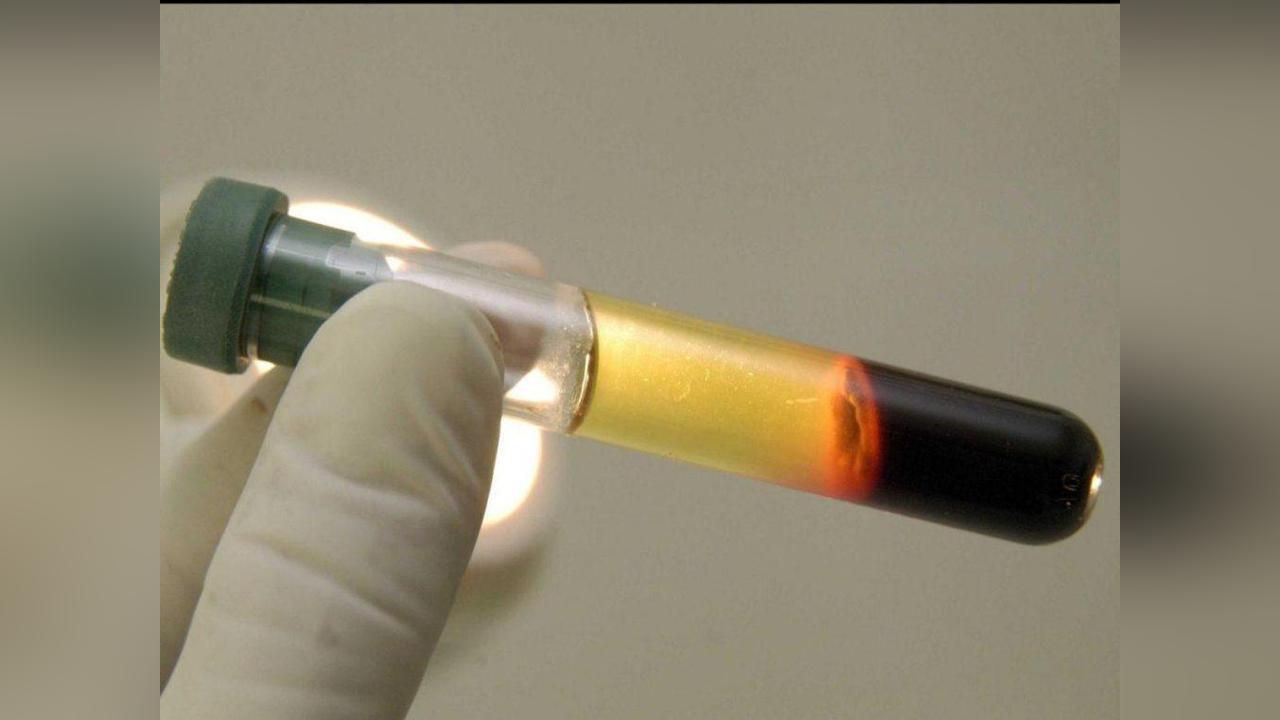 “Mauvais” cholestérol : on sait pourquoi il s’accumule dans le sang ...