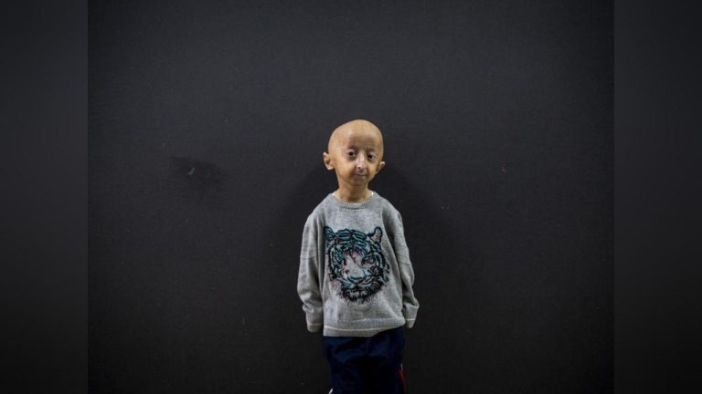 Gène de Centenaires Contre la Progéria Rarissime - Comores