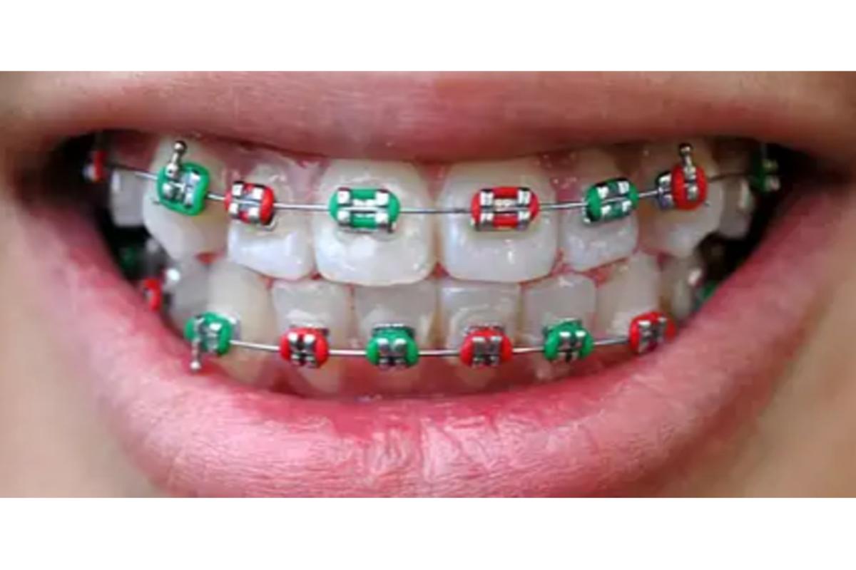 What Foods Should I Avoid After Getting Braces Ethiopia