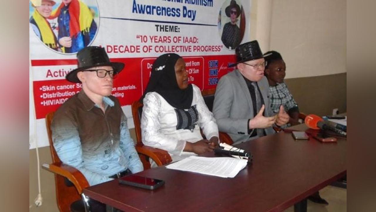 Relief for Albinos as Govt Scraps Taxes on Protective Lotion - Uganda
